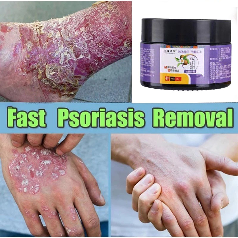 Removal eczema psoriasis ringworm Ubat gatal kulit Antifungal Eczema ...