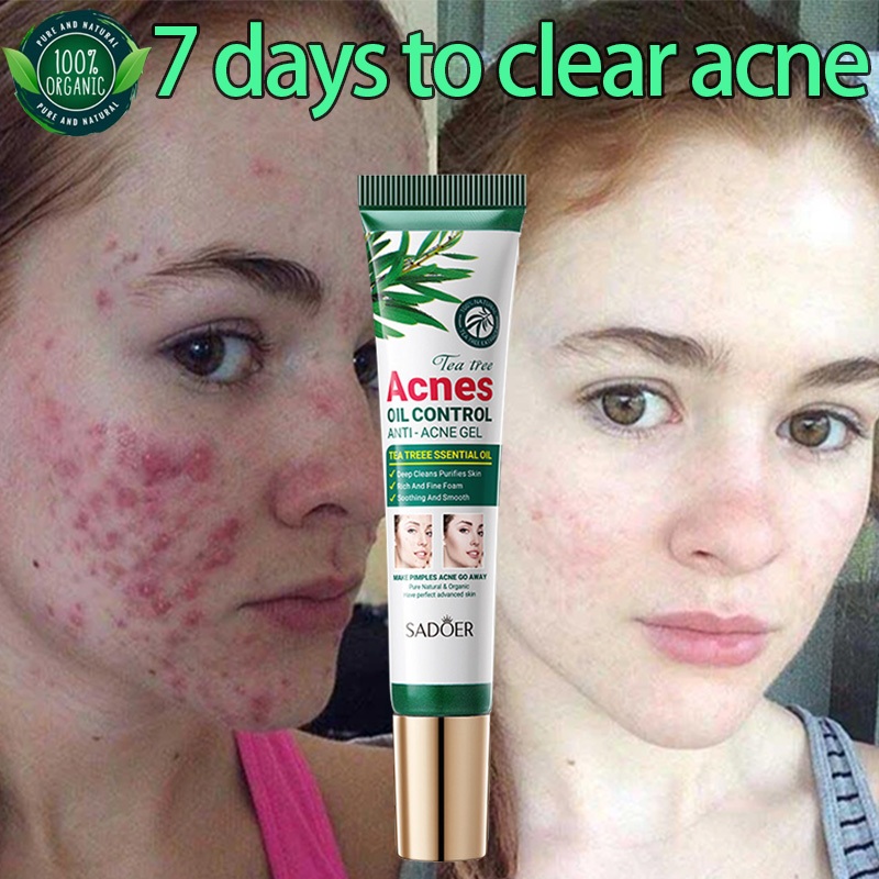 Tea Tree Acne Gel krim jerawat 祛痘膏 Quickly and effectively remove ...