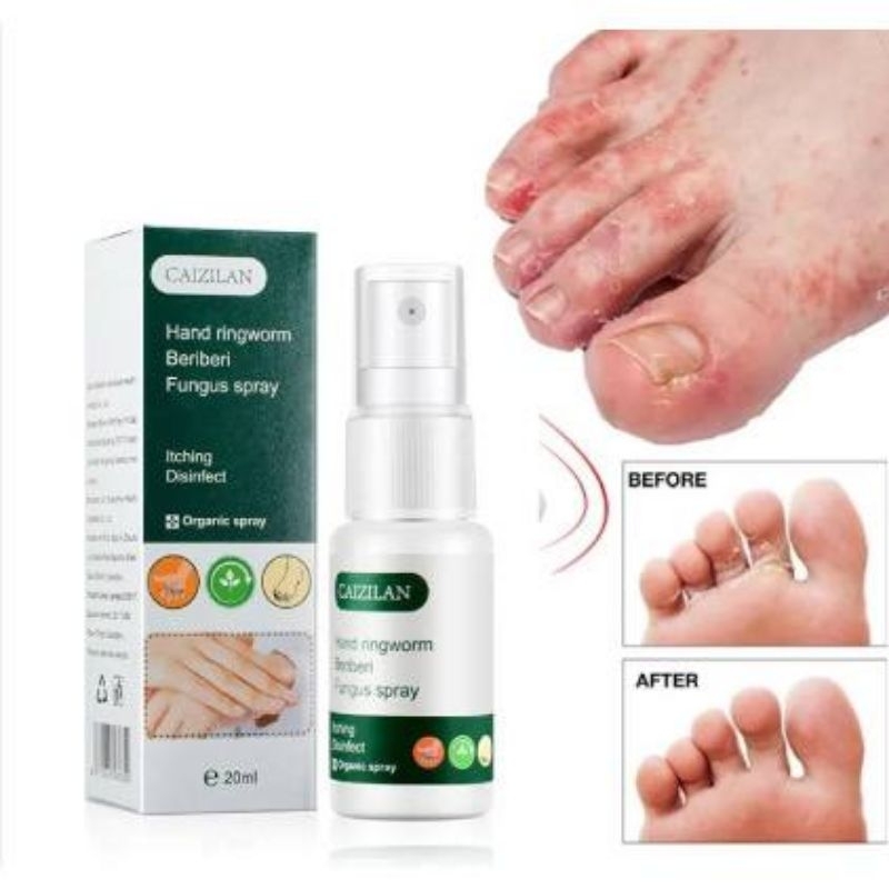 CAIZILAN Hand nail Ringworm beriberi fungus spray Terapi rawatan kuku ...