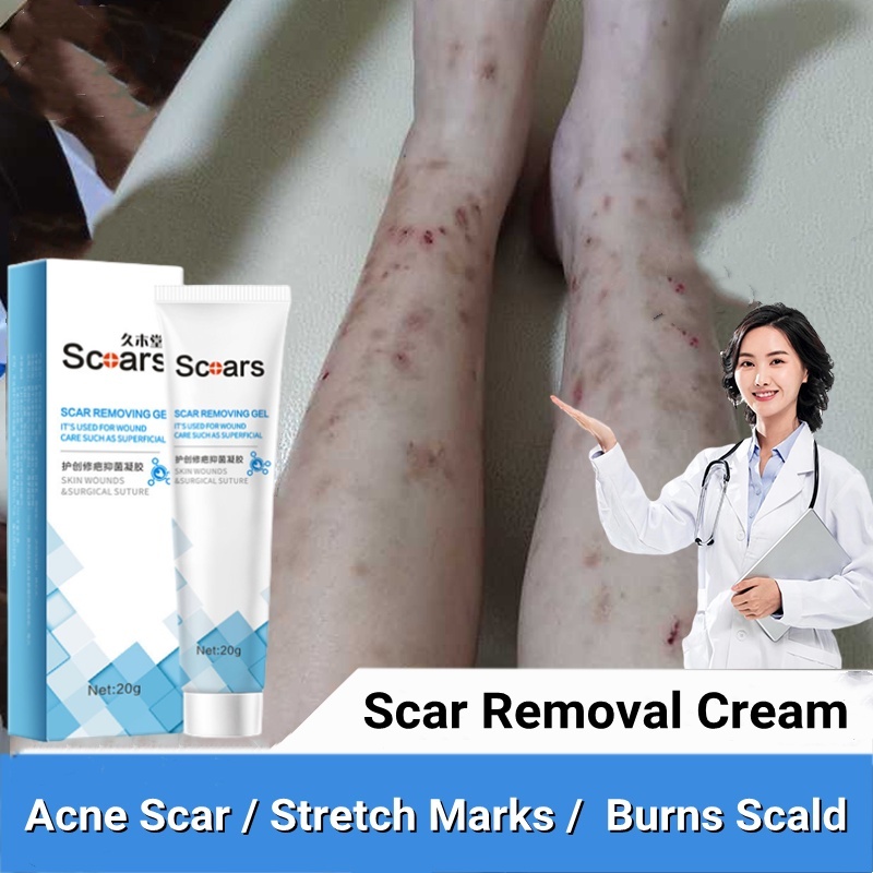 krim hilangkan parut hitam Scar Removal Cream Scar Repair Gel Keloid ...