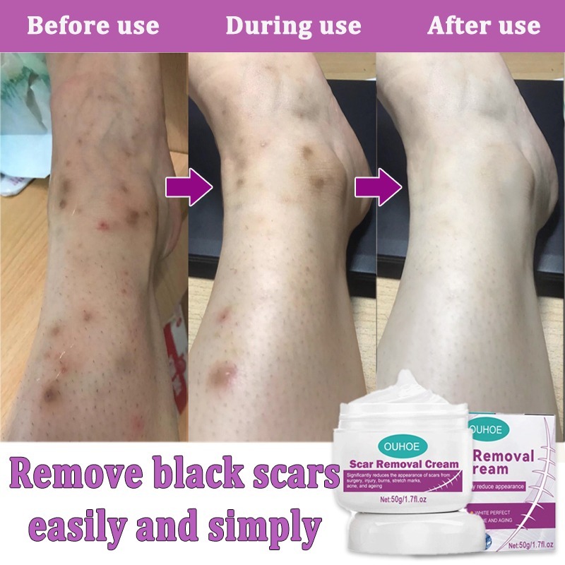 Krim hilangkan parut hitam Menghilangkan bekas luka lama Ubat parut ...