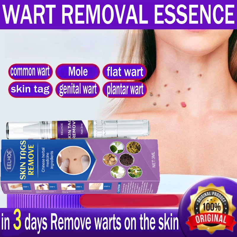Wart Removal Essence Ubat buang kutil ketuat tahi lalat biji kolestrol ...