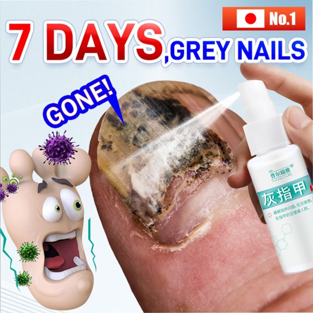 Ubat kuku rosak fungus nail treatmen Japan Anti Fungal Spray Skin Care ...