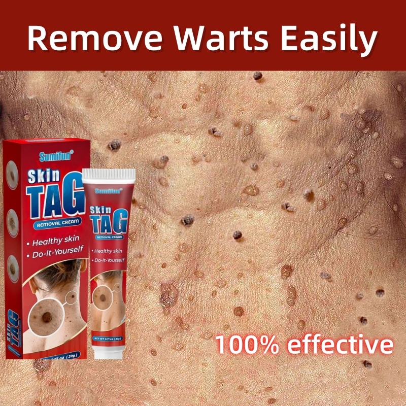 Ubat ketuat Skin tag remover Ubat kutil Tahi lalat remover Warts ...