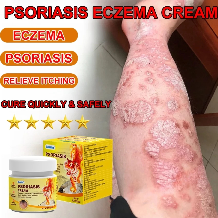 Herbal itchy Antibacterial Skin Cream Antifungal For Eczema Dermatitis ...