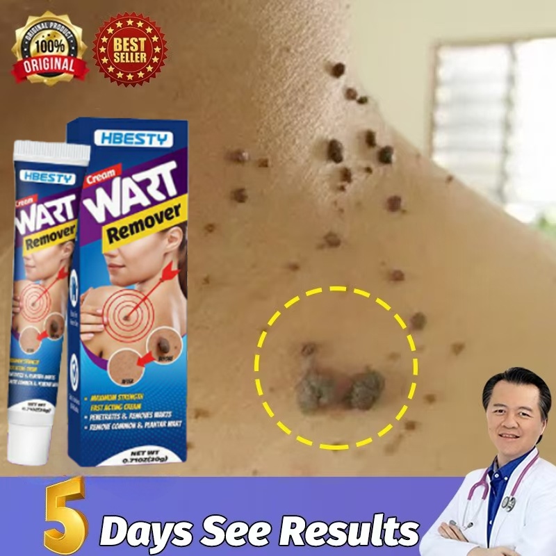 Warts removal cream Ubat kutil tahi lalat ketuat dan biji kolesterol ...