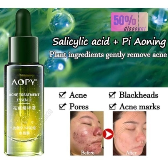 Malaysia local/Acne serum penghilang lubang jerawat serum Remove acne ...