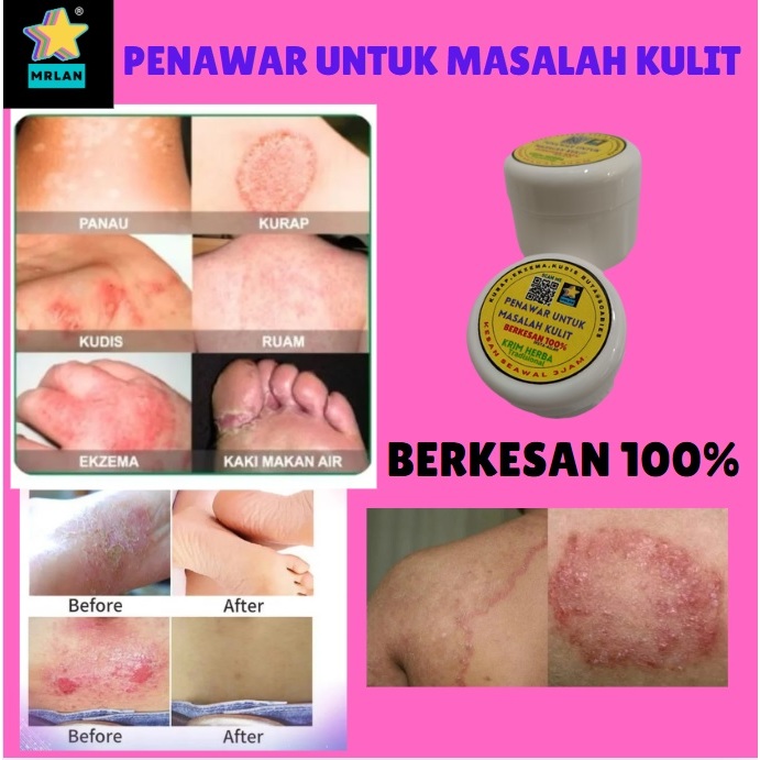 UBAT KURAP EKZEMA SCABIES PSORIASIS PANAU MAKAN AIR DAN MASALAH KULIT ...