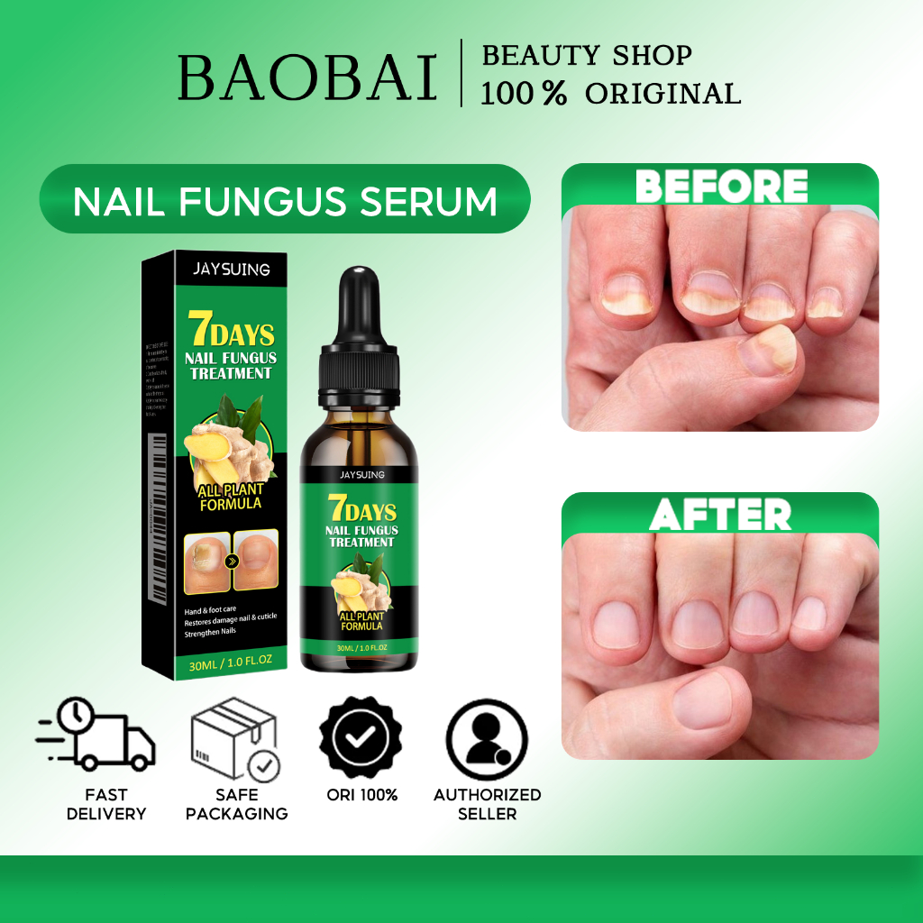 Jaysuing 7days Nail Fungus Treatment Serum Ginger Antibacterial Nail Treatment Anti ...