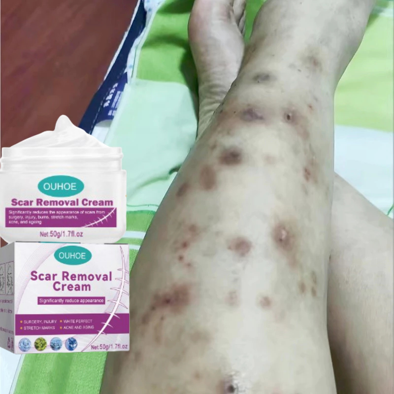 krim hilangkan parut hitam Menghilangkan bekas luka lama Ubat parut ...