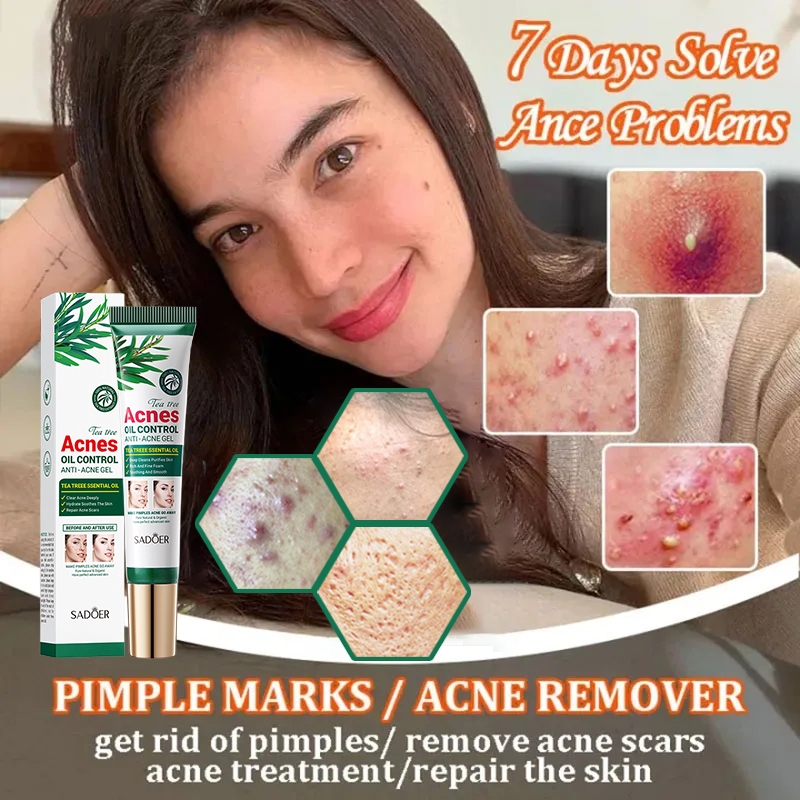 ubat jerawat acne spot treatment tea tree pimple cream hilangkan parut ...