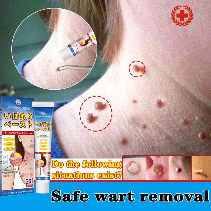 Japan Wart Removal Cream Ubat buang kutil ketuat tahi lalat biji ...