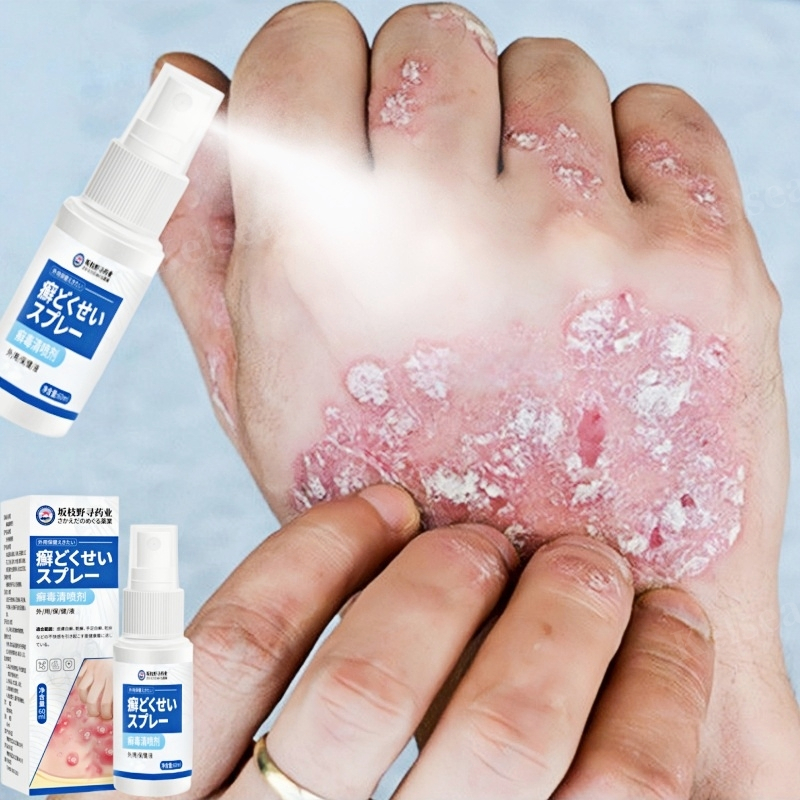 Psoriasis spray ubat kurap ubat gatal kulit Treat psoriasis/eczema ...