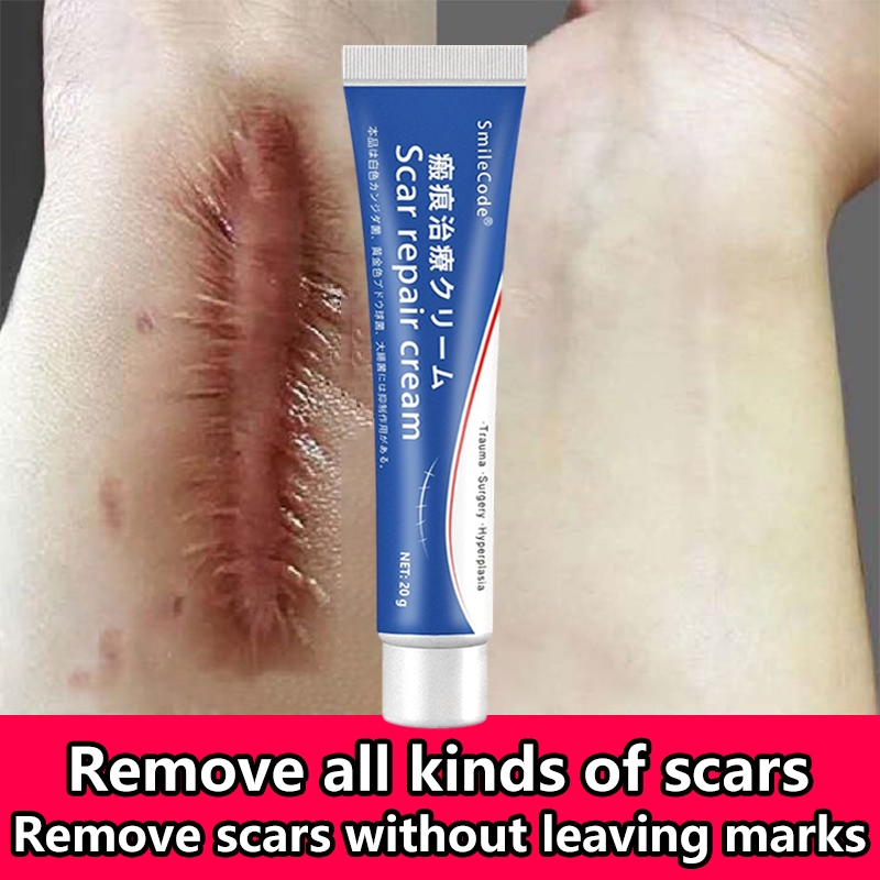 Scar Removal Cream 20g Remove Stretch Marks Burns Scald Repair ...