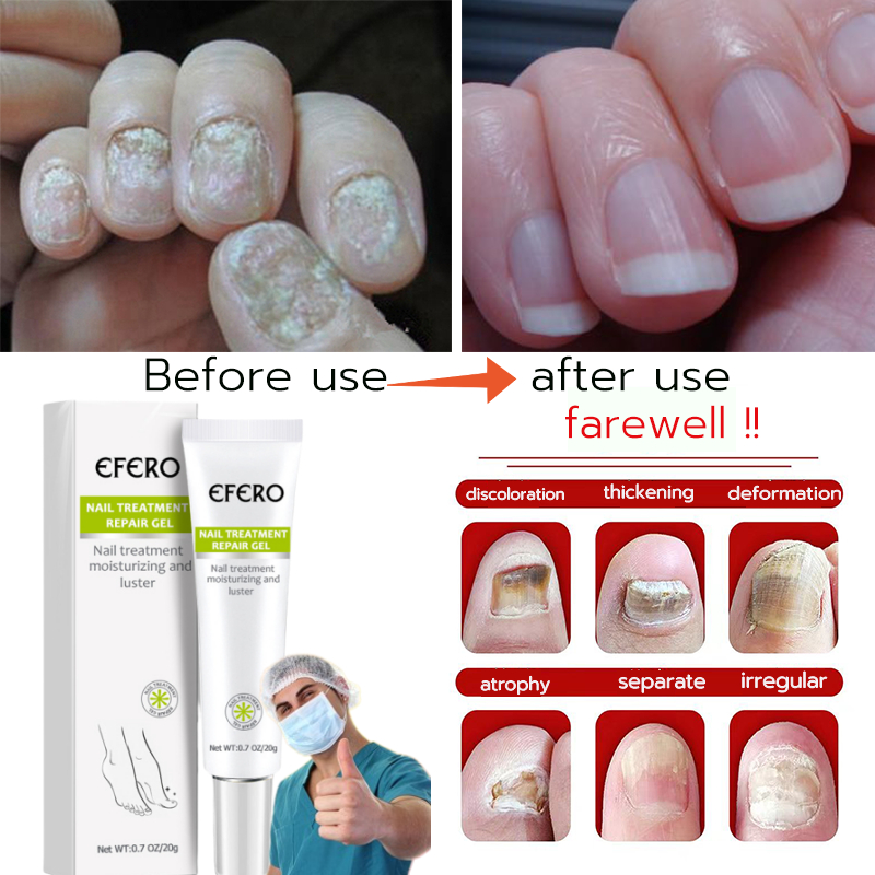 Ubat Kuku Rosak Fungus Nail Fungus Treatment Liquid Ubat Kulat Kuku ...