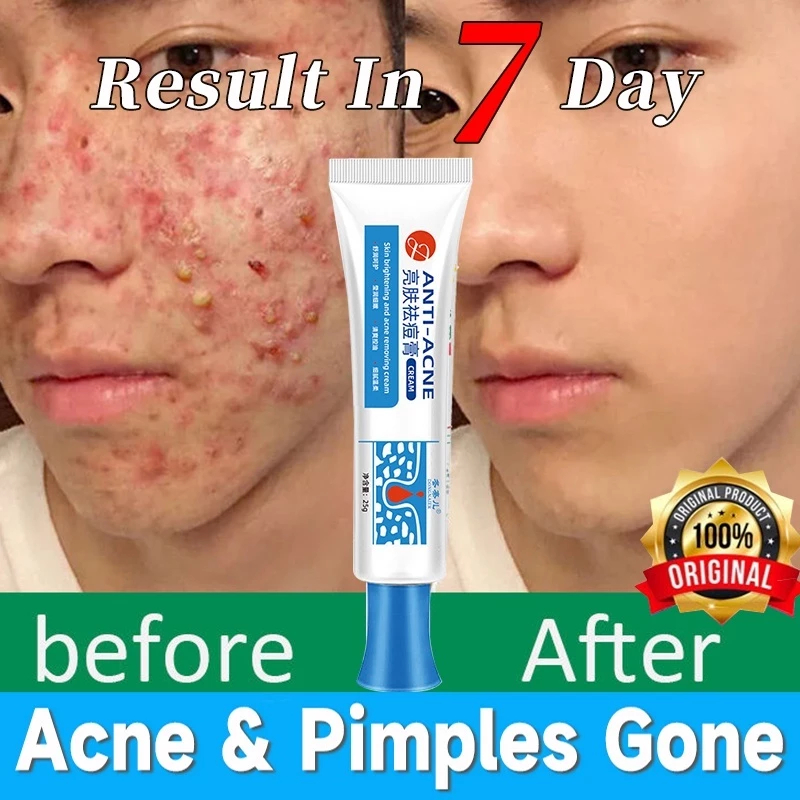 Acne Cream Anti Acne ubat jerawat berkesan Pimple cream Cream Muka ...