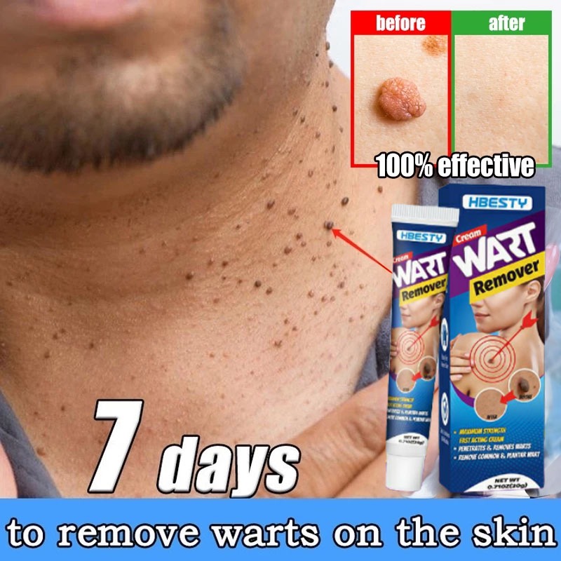 Ubat ketuat Wart removal cream wart remover skin tag removal kutil ...