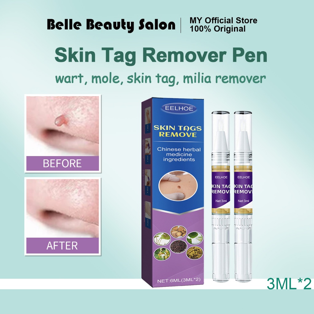 Ubat ketuat Skin tag remover pen 2pcs Wart Tahi lalat Milia remover ...
