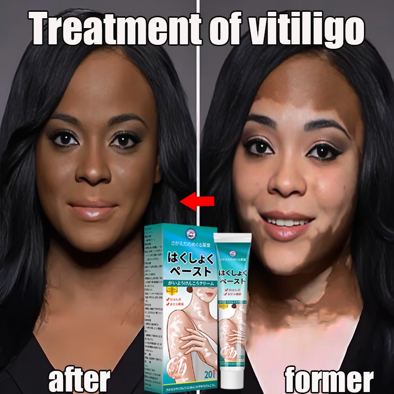 vitiligo cream original vitiligo treatment 20g Herbal formula is a safe ...