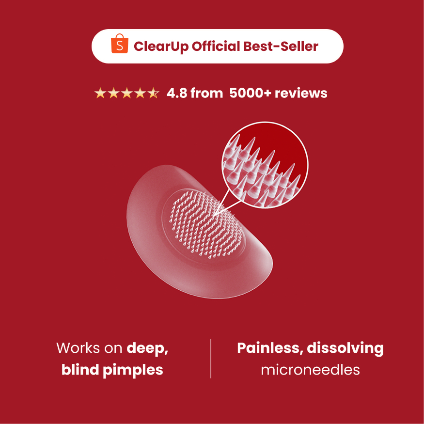 ClearUp Microdarts for Acne | Microneedle Patches for Blind Pimples | Pure Hydrocolloid Skincare ...