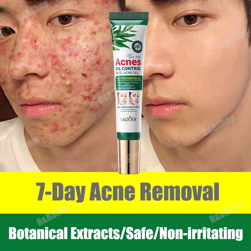 Acne serum Acne cream Pimple cream 20g Acne treatment gel Effective ...