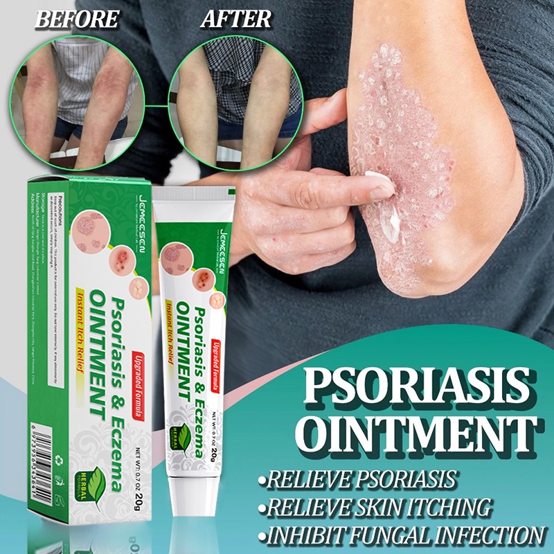 Jemeesen Psoriasis Cream Eczema Cream Herba Cina Fast Relieve Itching ...