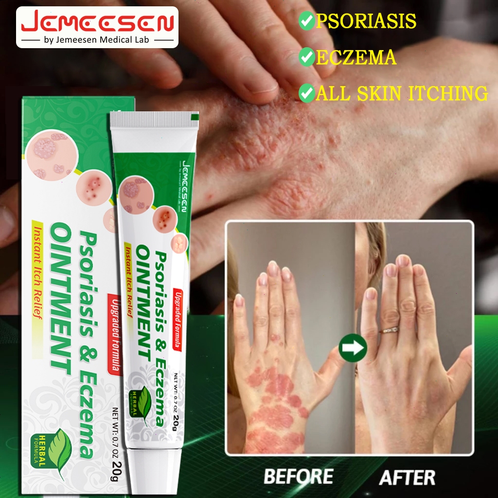 Jemeesen Psoriasis Cream Eczema Cream Herba Cina Fast Relieve Itching ...
