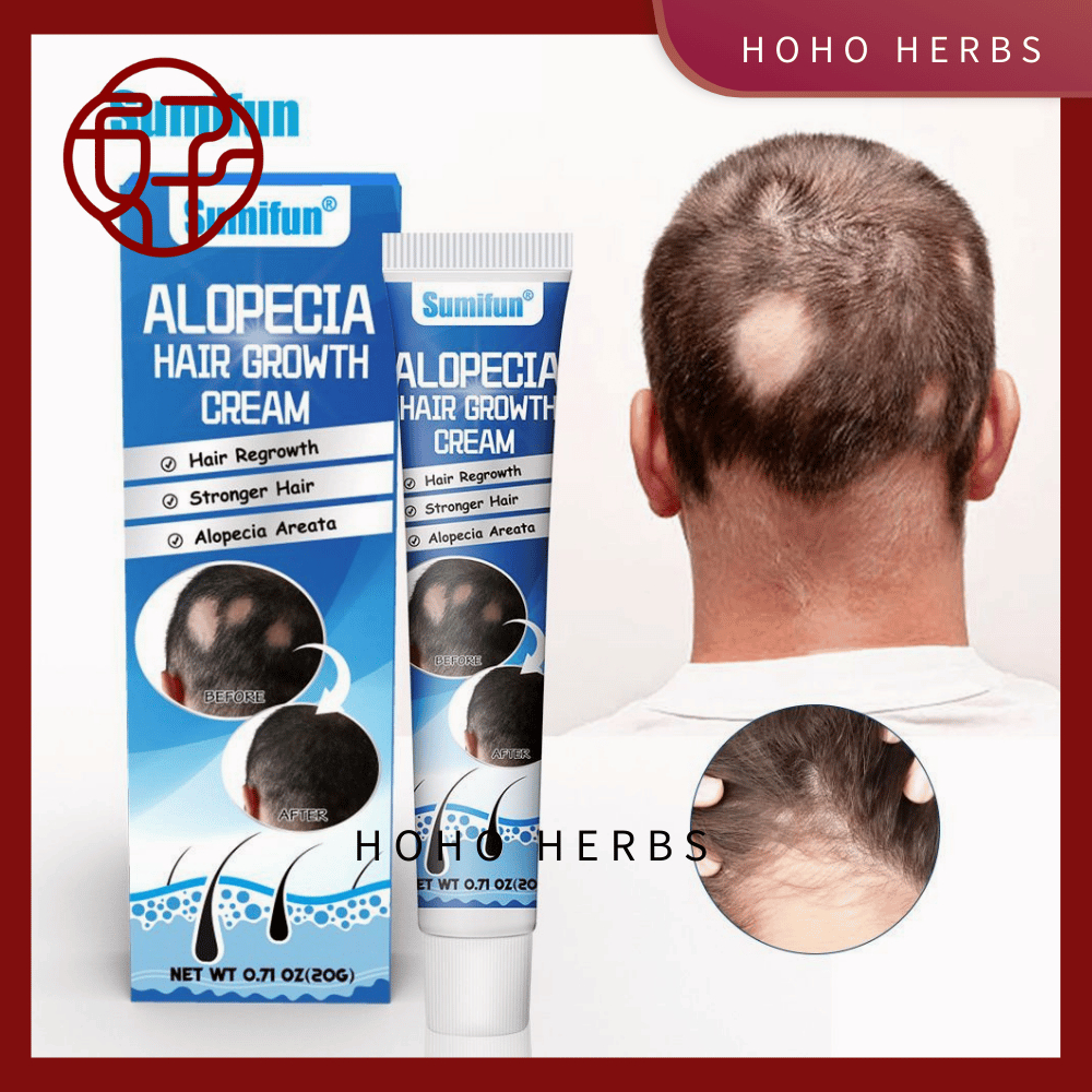 Sumifun斑秃膏 Alopecia Hair Growth Cream 20g Fast Hair Growth Oil Baldness ...