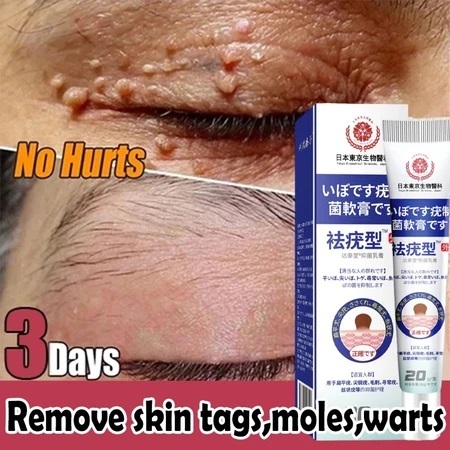 Warts removal cream ubat kutil buang tahi lalat dan biji kolestrol Skin ...
