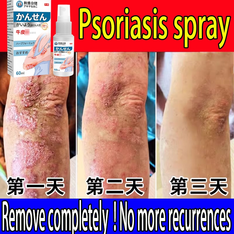 Psoriasis spray anti itch eczema 60ml relief ubat gatal kulit herba ...