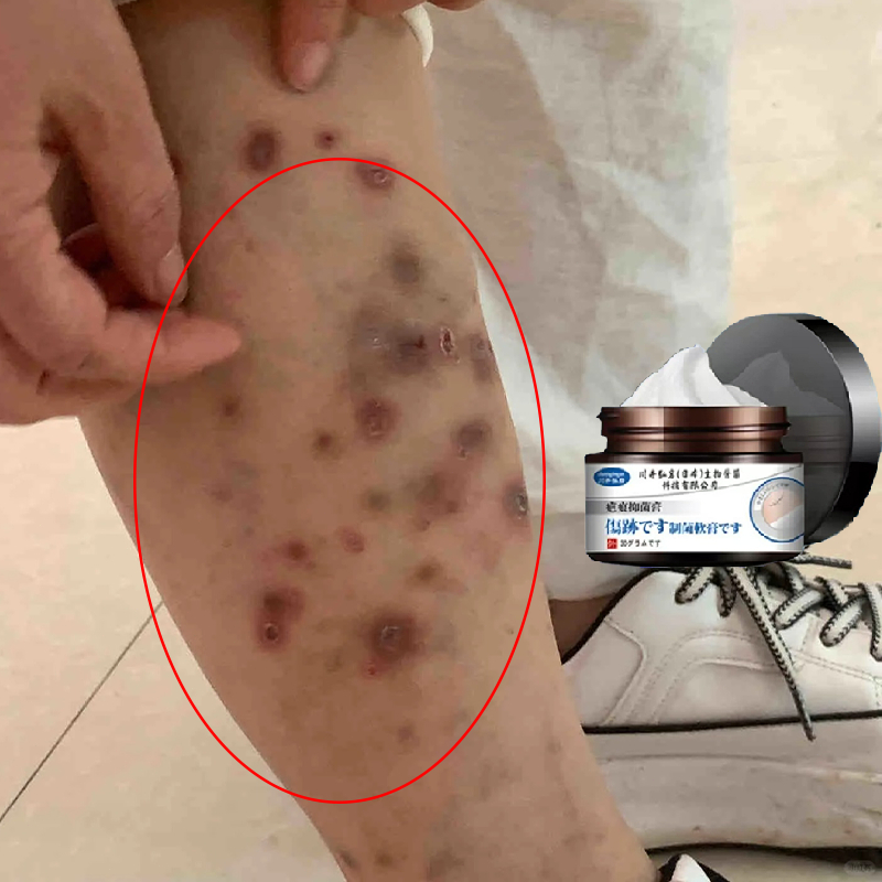 krim hilangkan parut hitam scar removal cream hilangkan parut kaki ...