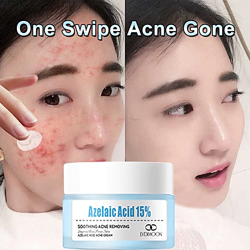 Acne Cream Acne gel acne scar 30g Quickly remove acne and lighten acne ...