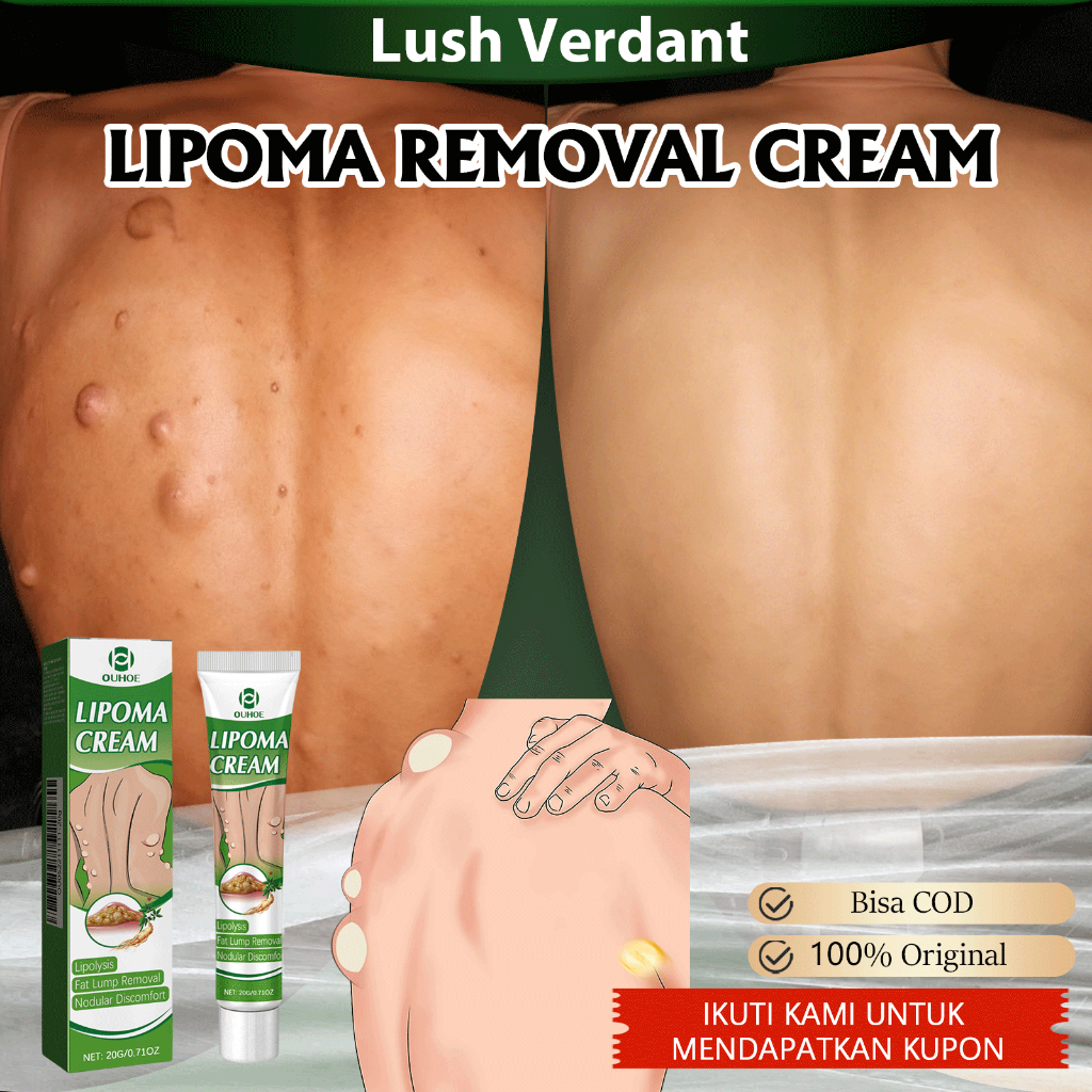 Lipoma Removal Cream 20g Fat Granule Care lipoma Removing Lumps in the ...