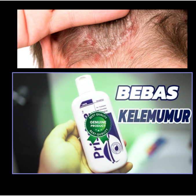 Psoriasis Shampoo Anti Dandruff Shampoo Anti-itch shampoo For Sensitive ...