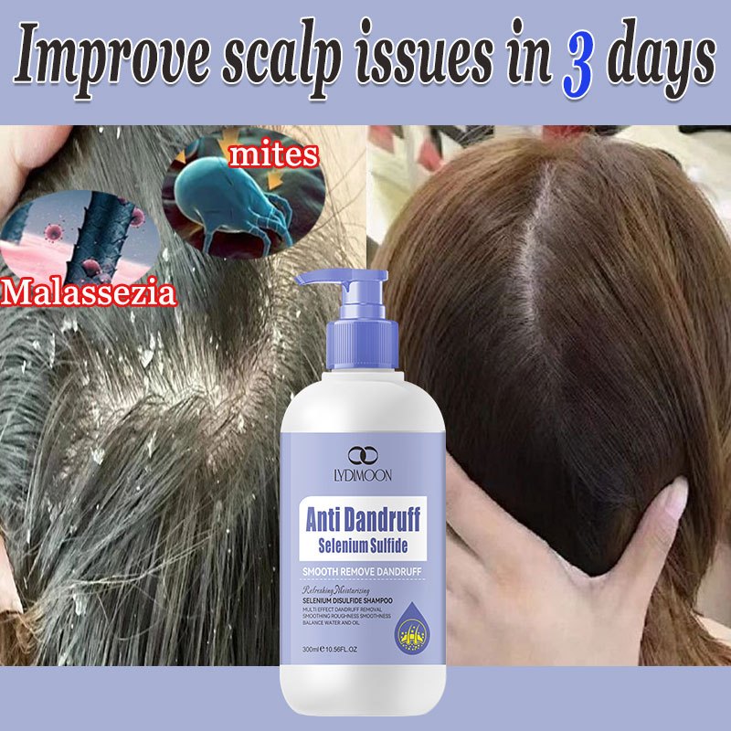 Anti-Dandruff Shampoo Selenium Disulfide Shampoo Eliminates Dandruff ...