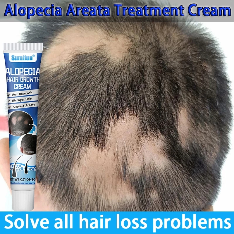 Baldness Cream Alopecia Hair Growth Cream20g Alopecia Fast Hair Growth ...