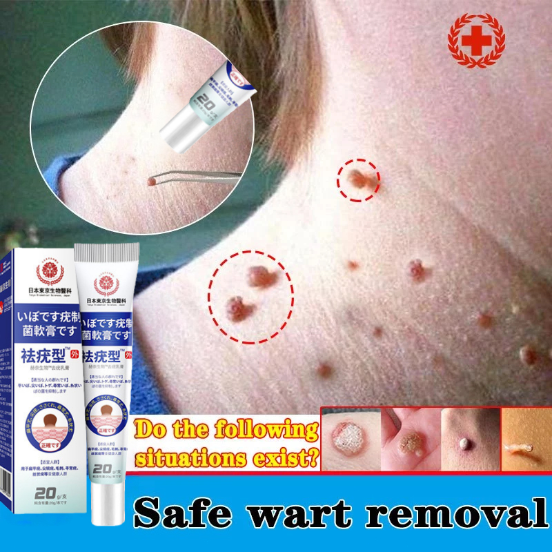 Singkir Tahi Lalat Ketuat Ketuat Kaki Kutil Skin Tag Mole Wart Corn ...