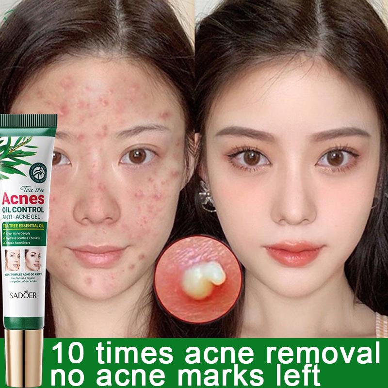 Tea tree acne cream for acne repair without leaving acne marks ...