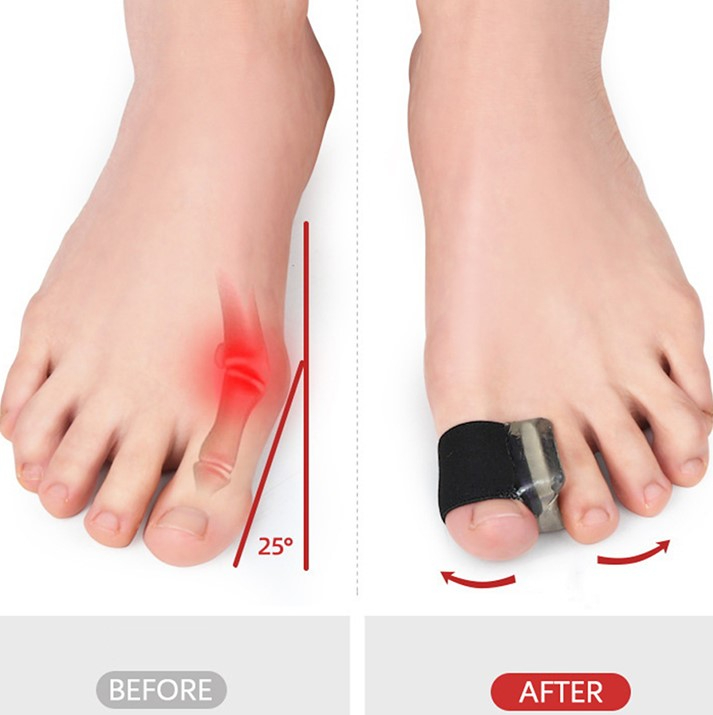 Toe Separator Insoles Ring Separation Hallux Valgus Correction Big Toes ...