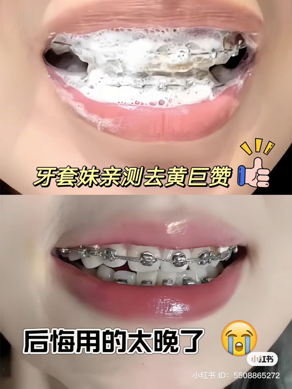 YAYASHI SP-4/SP-7 Probiotic Whitening Toothpaste 益生菌美白牙膏 | Shopee Malaysia