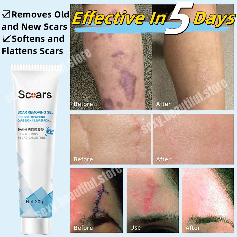 护创修疤抑菌凝胶 Scar Removal Gel Scar Repair Cream Stretch Marks Remover Scars ...