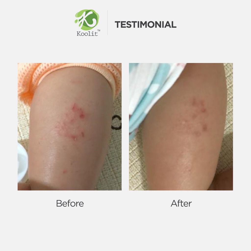 [100% ORIGINAL] KOOLIT COOLING BODY MOISTURISER ECZEMA KULIT GATAL ITCH ...