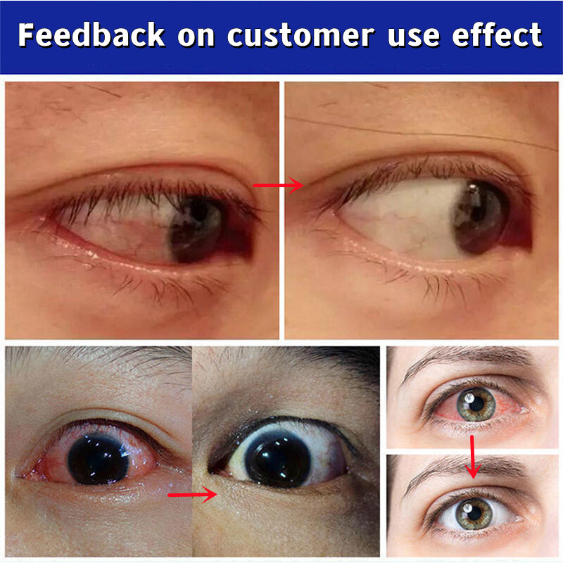 ubat mata jepun eye drops for dry eye ubat mata rabun selaput cataract ...