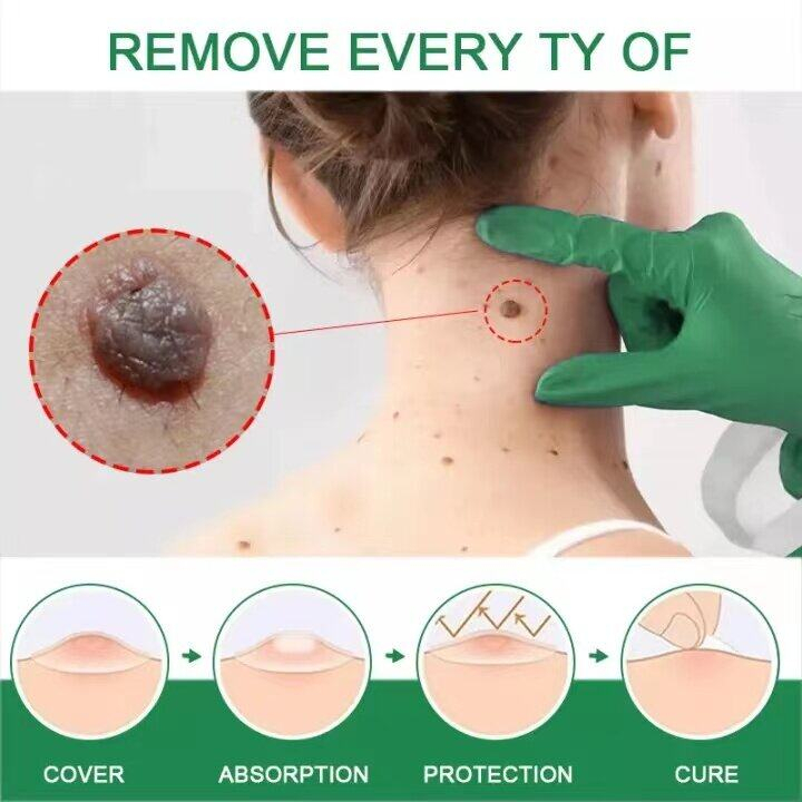 Wart Remover Pads Skin Tag Remover Patches buang tahi lalat kutil dan ...