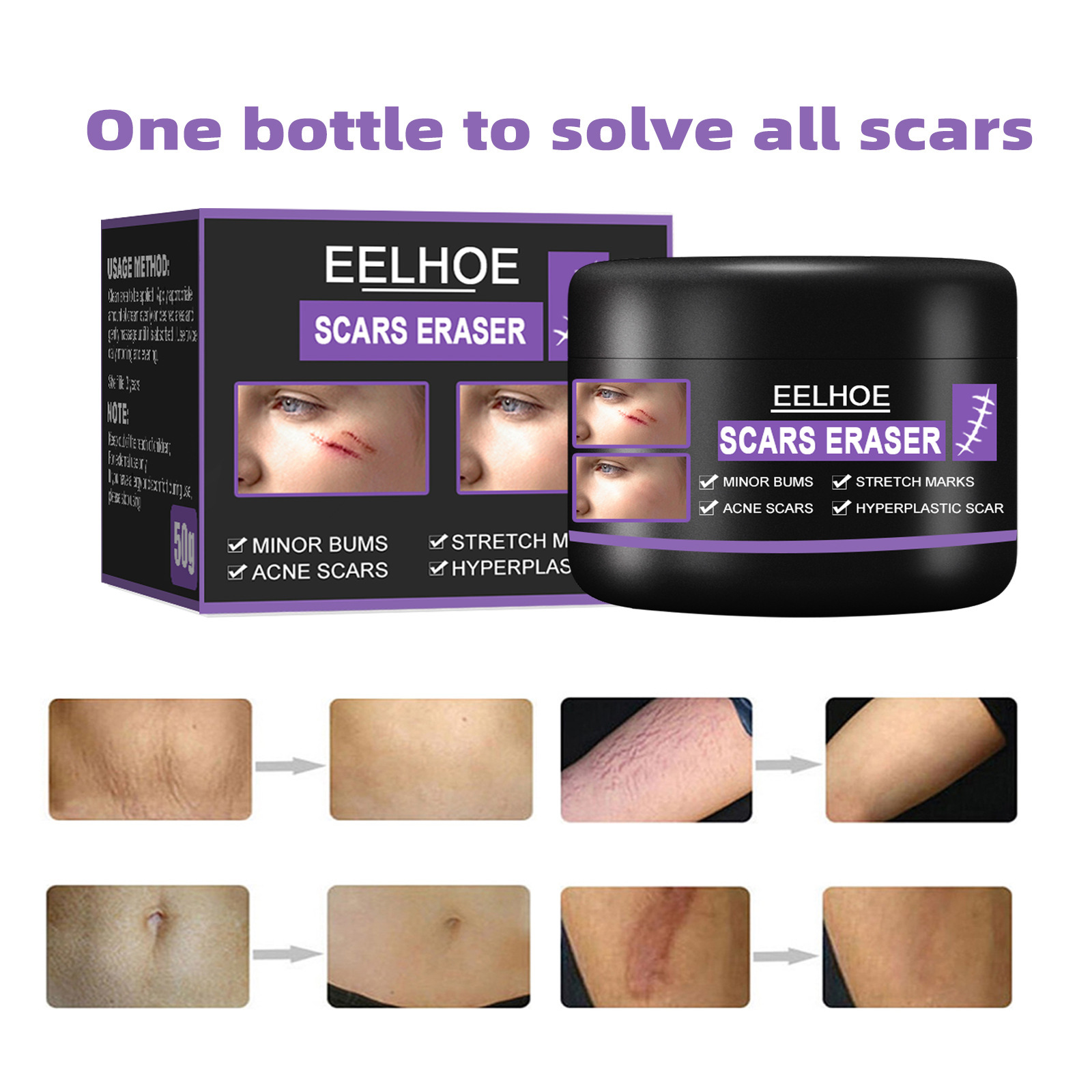 Ubat parut Krim Hilangkan Parut Hitam Scar Removal Cream Menghilangkan ...