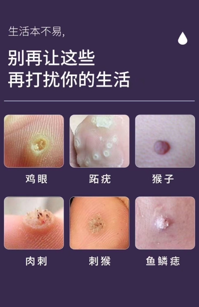 【快速去肉粒】克尤抑菌液颈部赘皮祛丝状尤腋下猴子温和去质膏[Removing Small Meat Granules from the ...