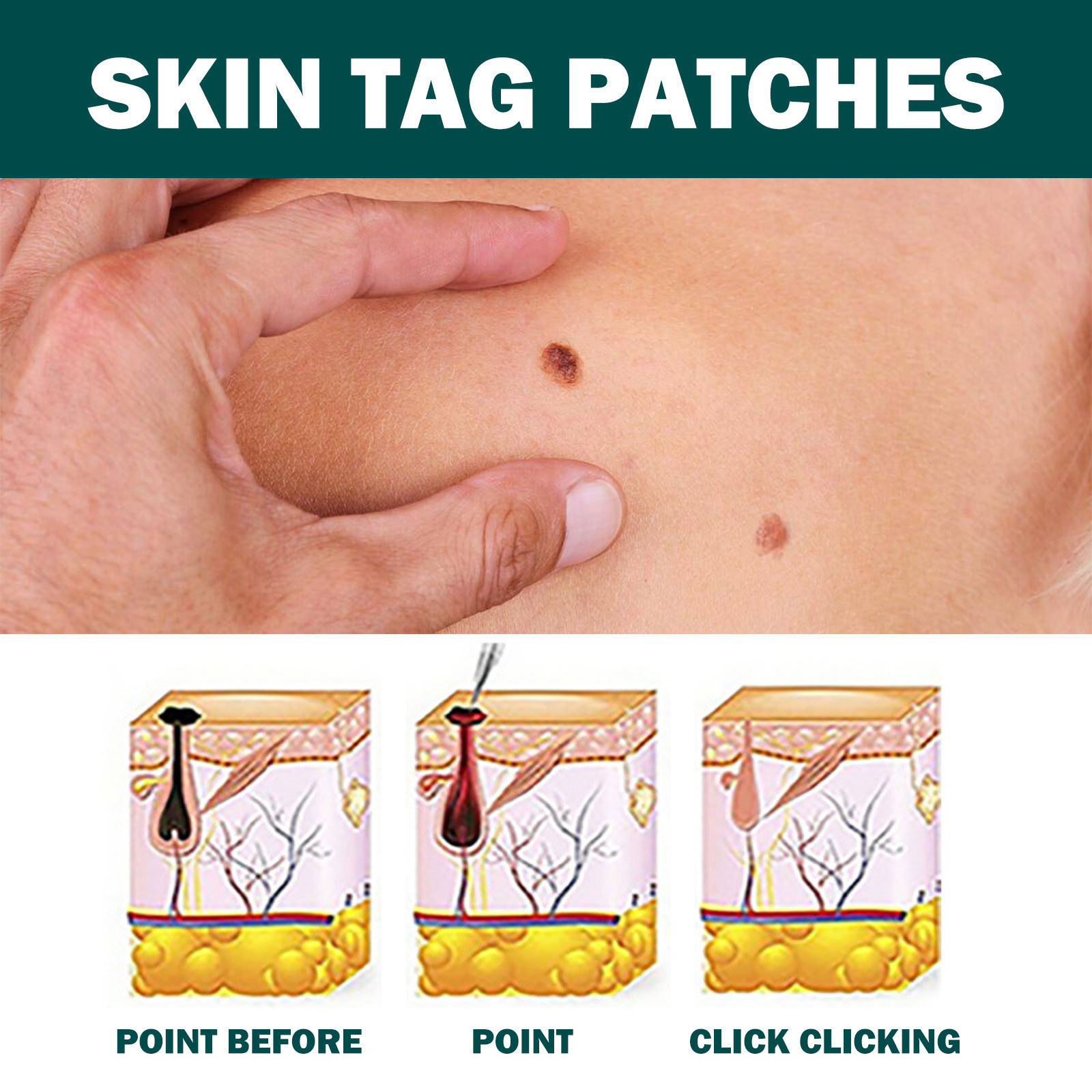 Wart Remover Pads Skin Tag Remover Patches buang tahi lalat kutil dan ...