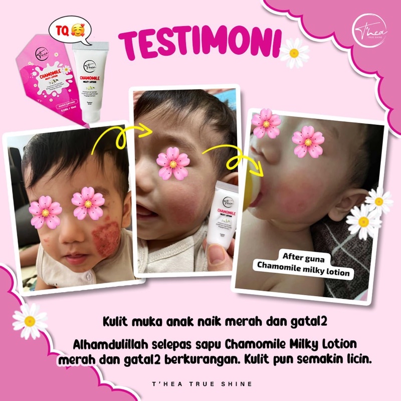 FREEGIFT Thea Chamomile Treatment Lotion eczema gatal elergik psiorasis ...