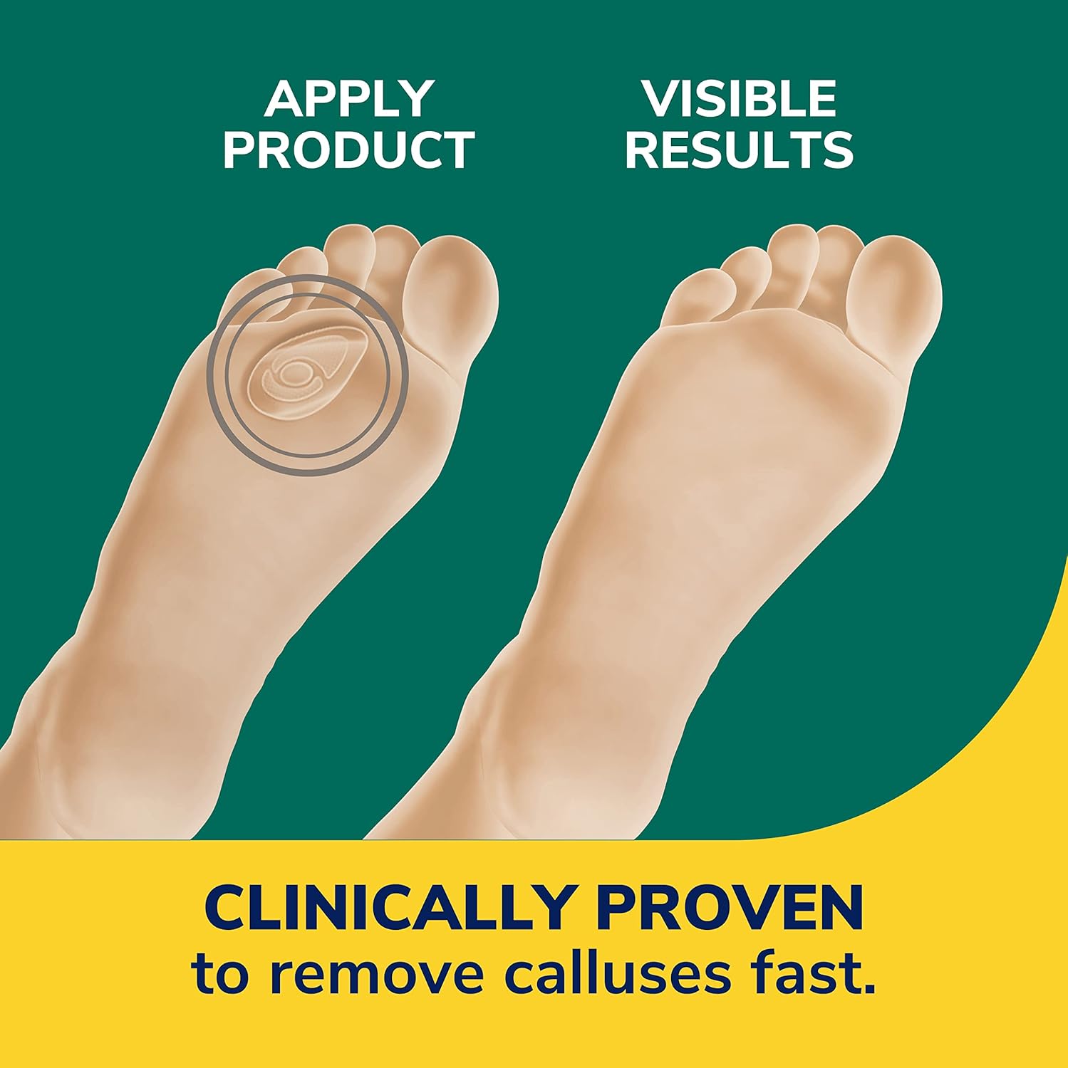 Dr Scholl's Callus | Corn| Bunion| Blister| Ingrown Toe nail| Moleskinl ...