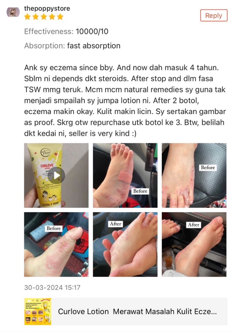 Thea Curlove soothing cream lotion baby Treatment gatal kulit eczema ...